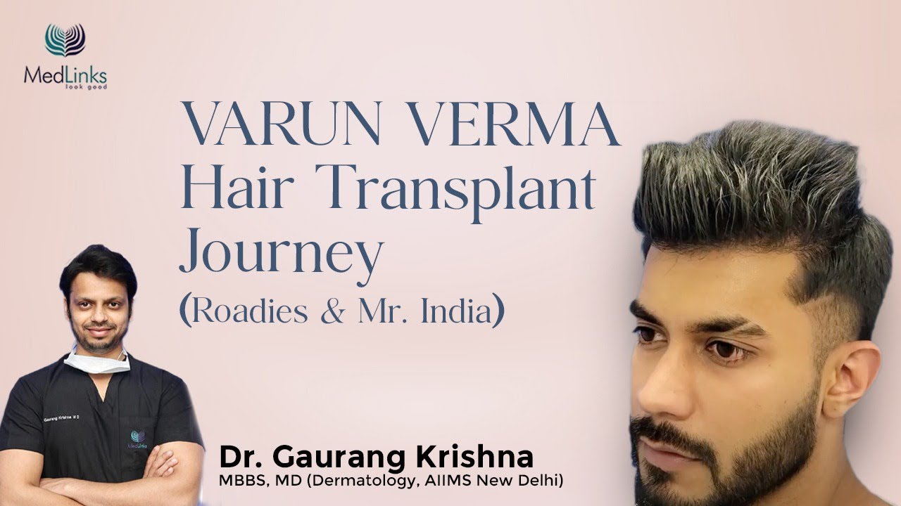 VARUN VERMA Hair Transplant (Roadies & Mr. India) Journey | Celebrity ...