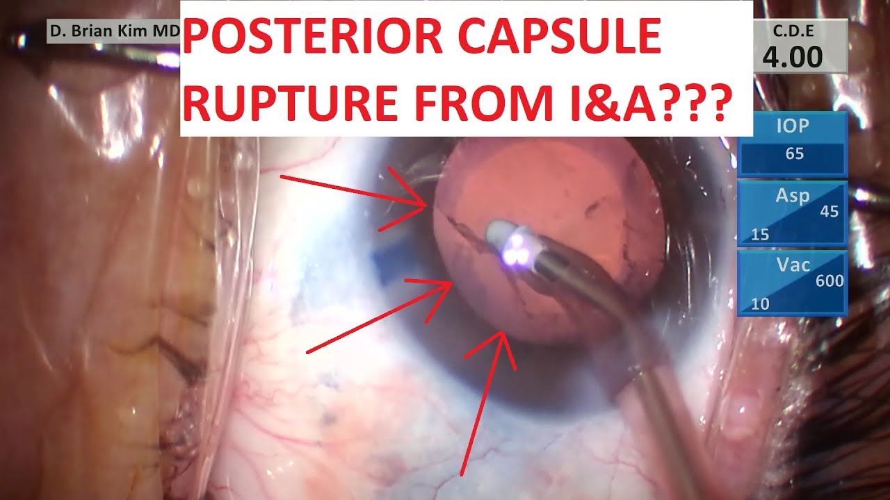 Dense White Cataract. Posterior Capsule Rupture from Polymer Tip?! How ...