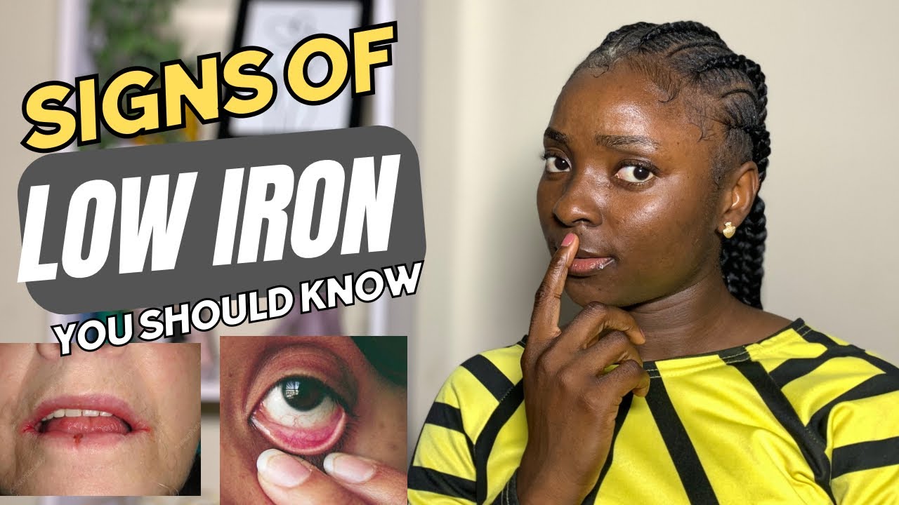 17 WARNING SIGNS OF IRON DEFICIENCY (skin, hair, nails, and heart ...