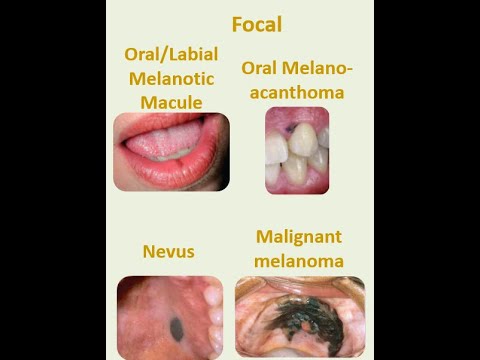 8. Focal melanosis - YouTube