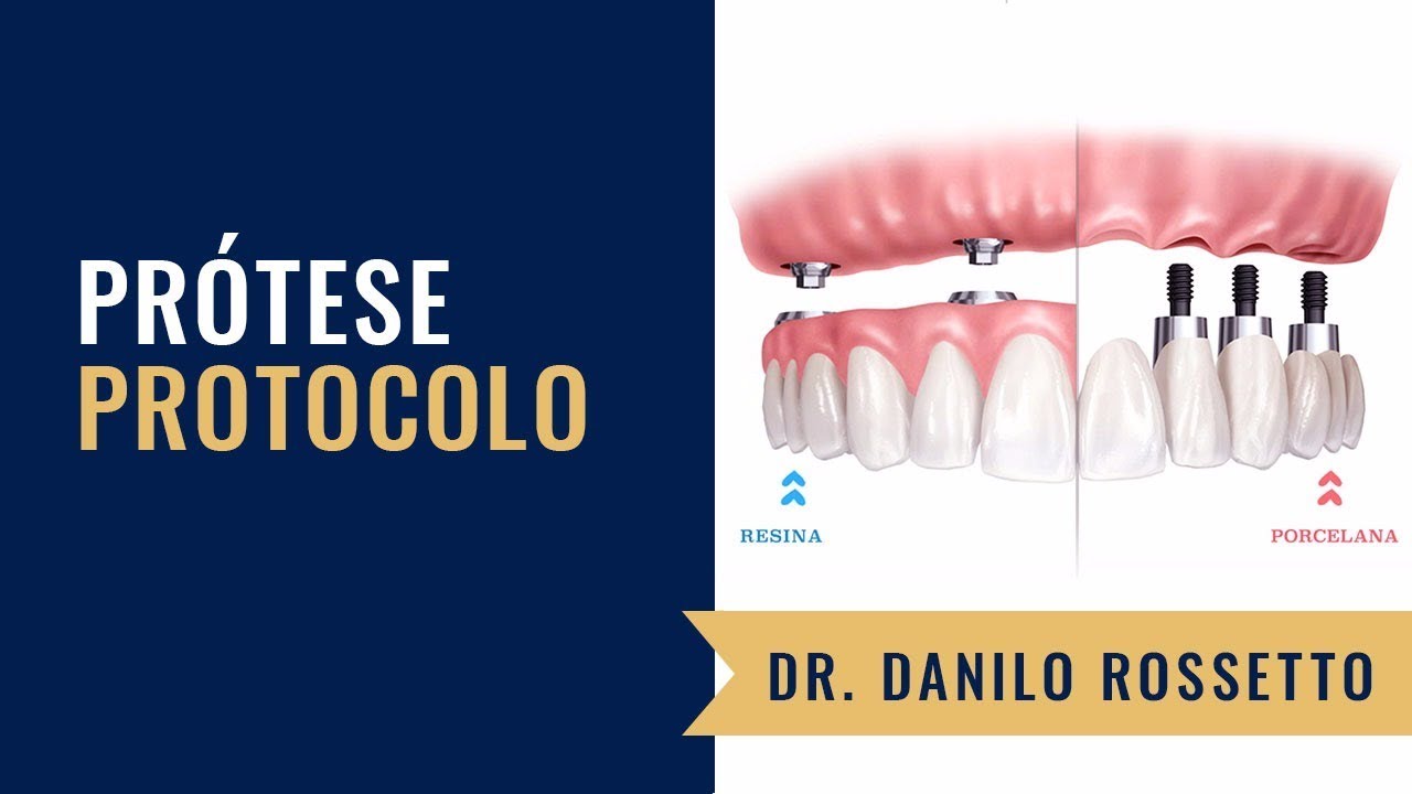 Prótese Protocolo - Prótese Total Fixa sobre implante - YouTube
