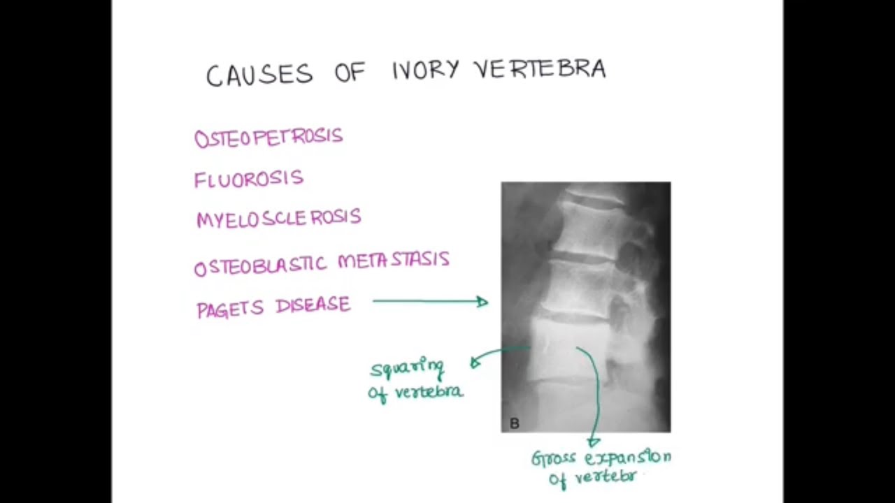 Causes of ivory vertebra #shorts - YouTube