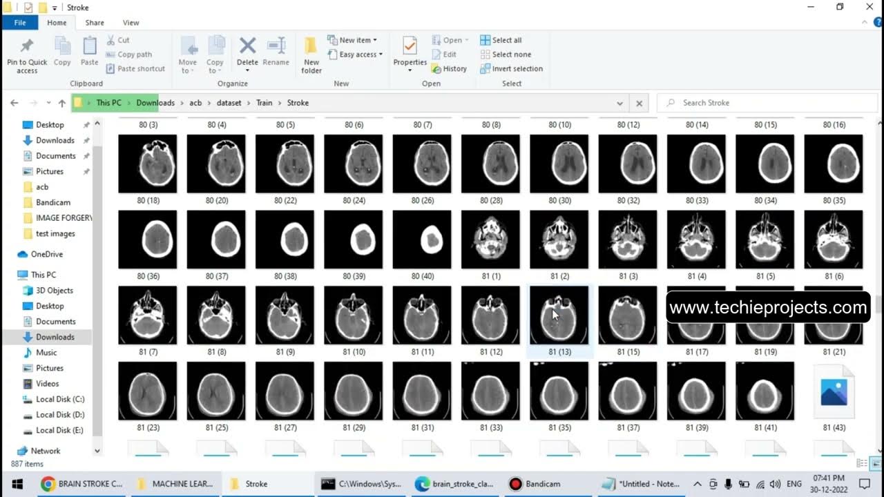 Brain Stroke Classification using CNN | Brain Stroke Detection using ...