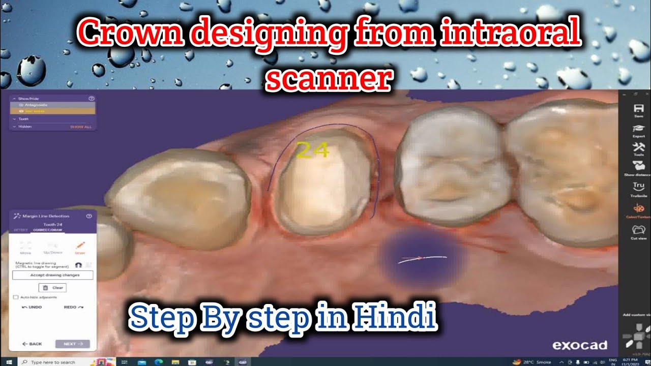 How to Crown design in Exocad/Exocad CAD CAM designing/ single crowns ...