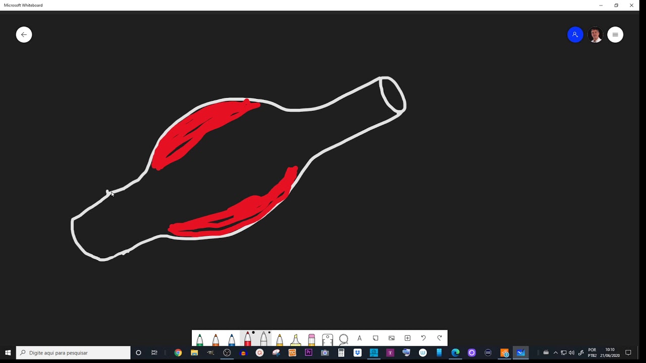 Aneurisma de aorta com fissuras no trombo mural - YouTube