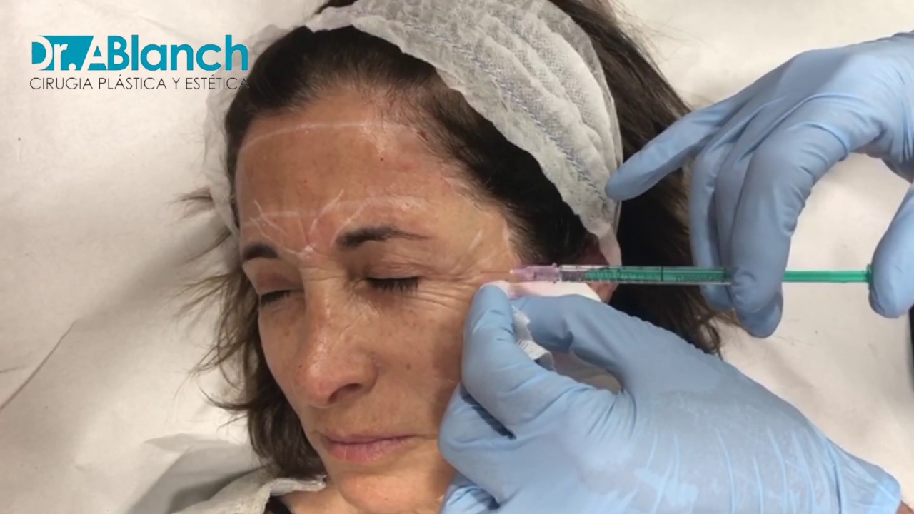 Todo lo que Necesitas Saber sobre el Bótox | Anatomía Facial y ...