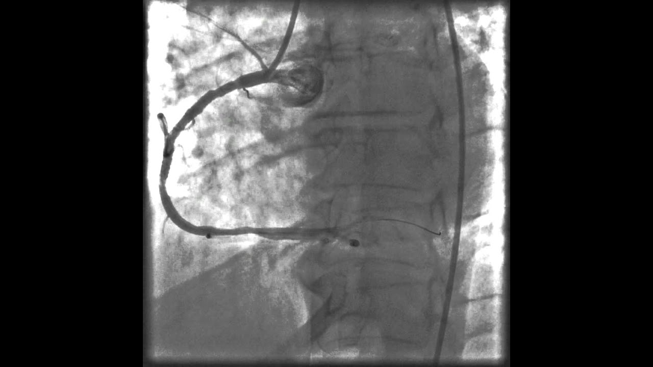 Stent en el corazón - YouTube