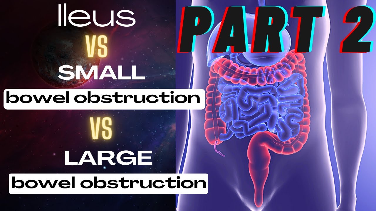 GENERAL SURGERY: Small bowel obstruction vs Large bowel obstruction vs ...