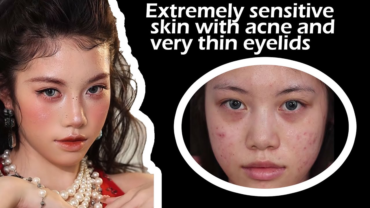 Extremely sensitive skin with acne and very thin eyelids - YouTube