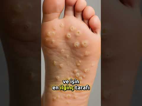 Siğil Nedir ve Neden Çıkar​?