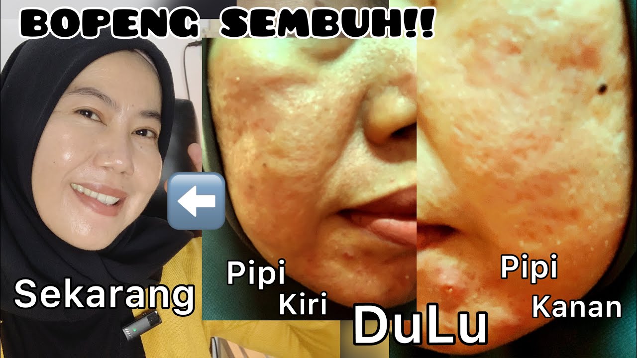 BOPENG HILANG DENGAN CARA INI || SHARING TREATMENT BOPENG || Hei Mega ...