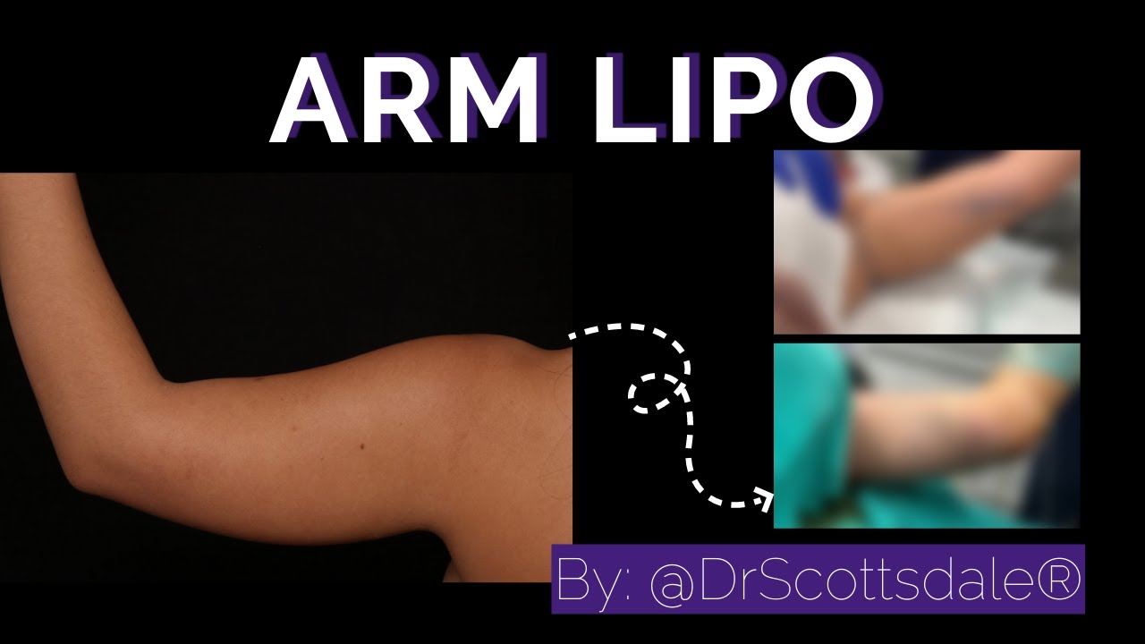 Arm Lipo by @DrScottsdale - YouTube