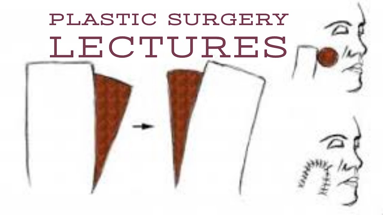 PLASTIC SURGERY lecture 1 GRAFTS types, survival and complications made ...