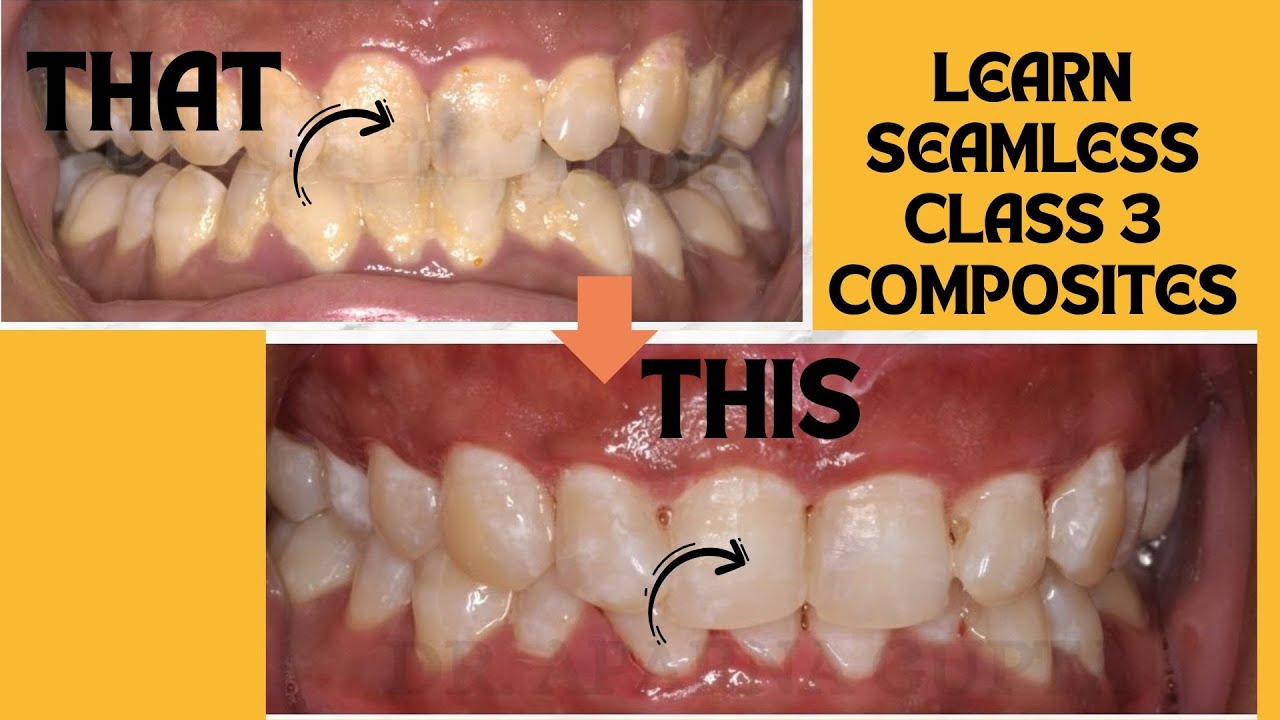 Class 3 Composite Restoration | Simple & Effective Technique ...