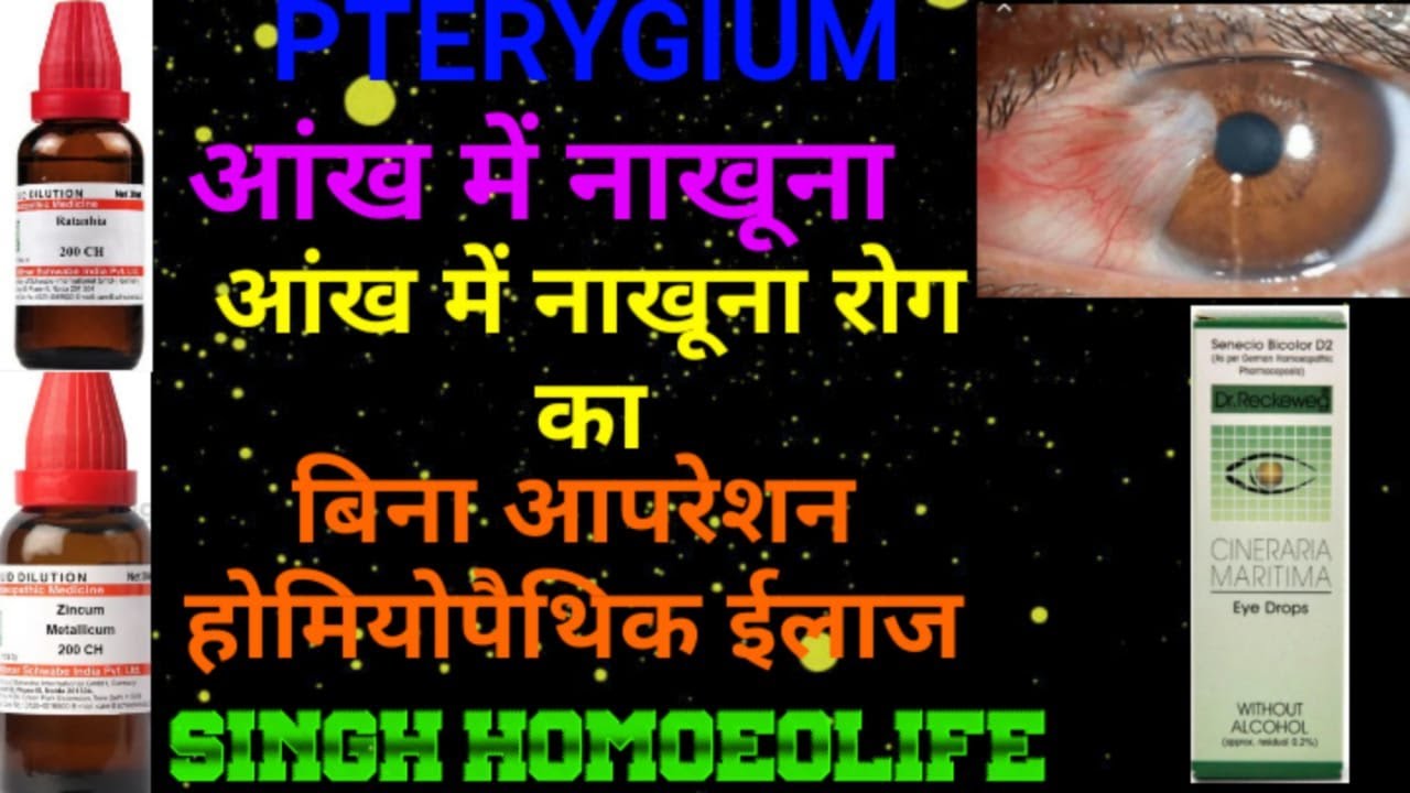 AANKH MEIN NAKHUNA/आंख में नाखूना रोग/PTERYGIUM/AANKH MEIN NAKHUNA ROG ...