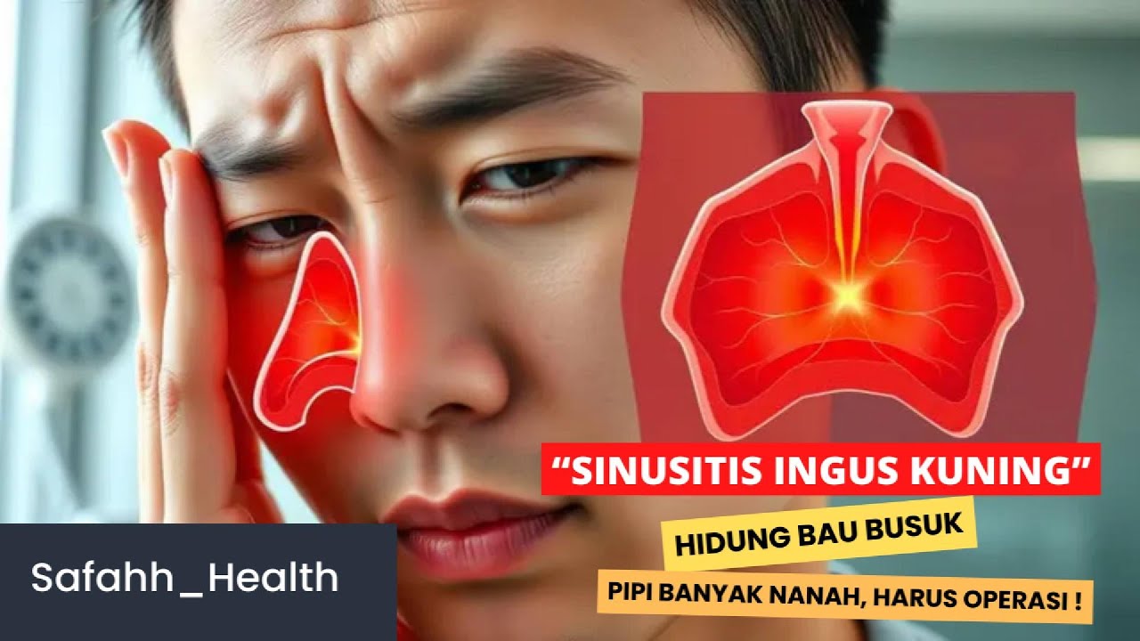 Ingus Kuning Pipi banyak Nanah dan Harus Operasi #safahhhealth # ...