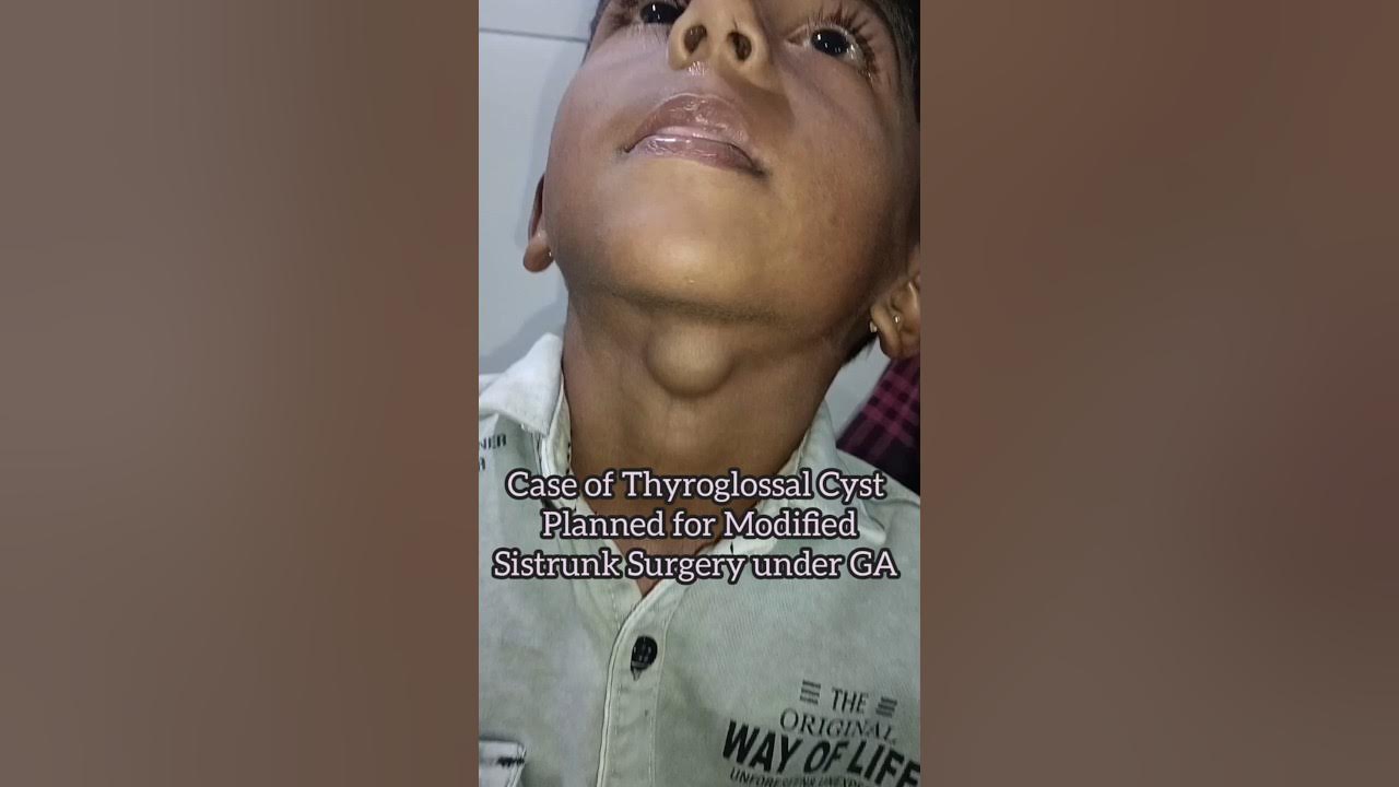 Modified Sistrunk Surgery for Thyroglossal Cyst removal under GA - YouTube
