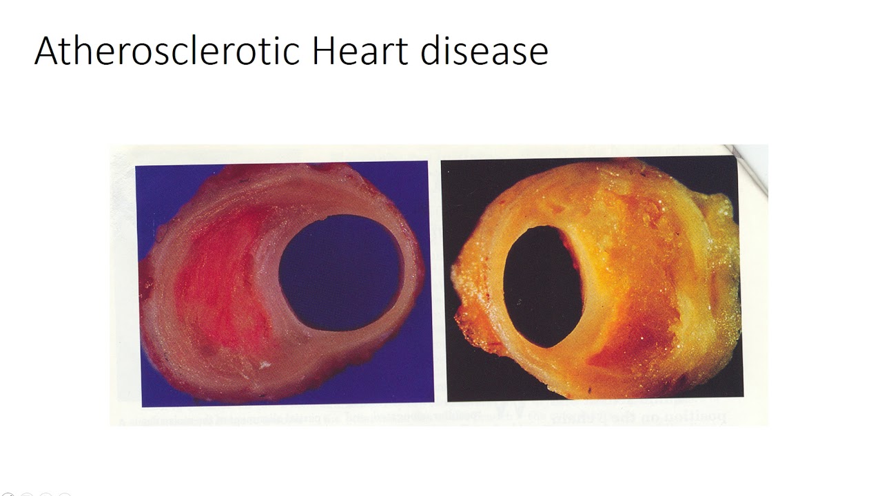 PVD and CAD 3: Coronary Artery Disease - YouTube