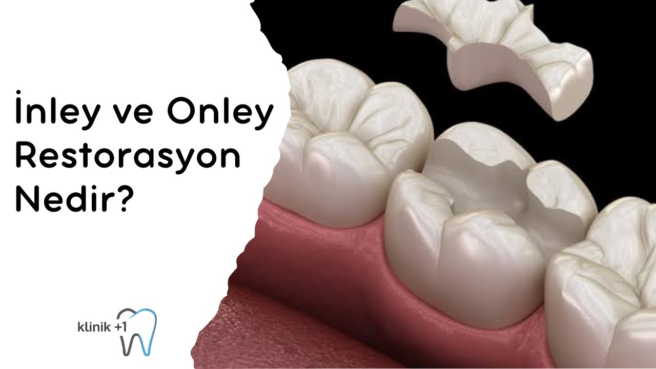 İnley / Onley Restorasyon Nedir ve Nasıl Yapılır? Detaylar Videoda ...