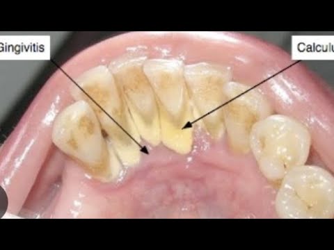 Get Rid of Dental Plague At Home/Dental Plague Removal. - YouTube
