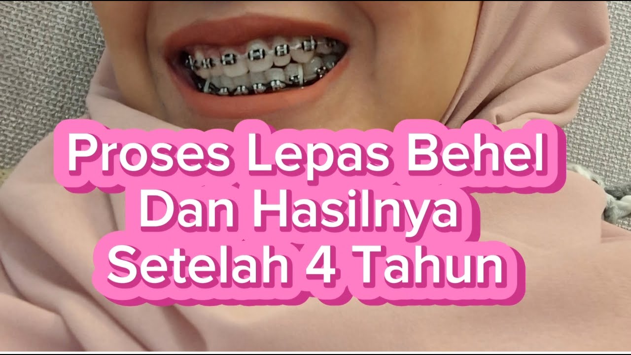 Proses Lepas Behel dan Perubahan Gigi Setelah 4 Tahun Pakai Behel - YouTube