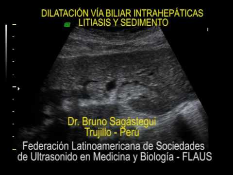 DILATACIÓN VÍA BILIAR INTRAHEPÁTICA CON LITIASIS Y SEDIMENTO - YouTube