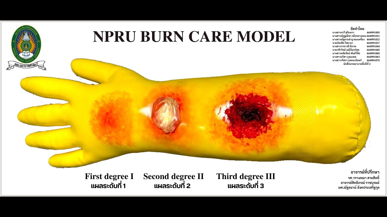 NPRU BURN CARE MODEL - YouTube