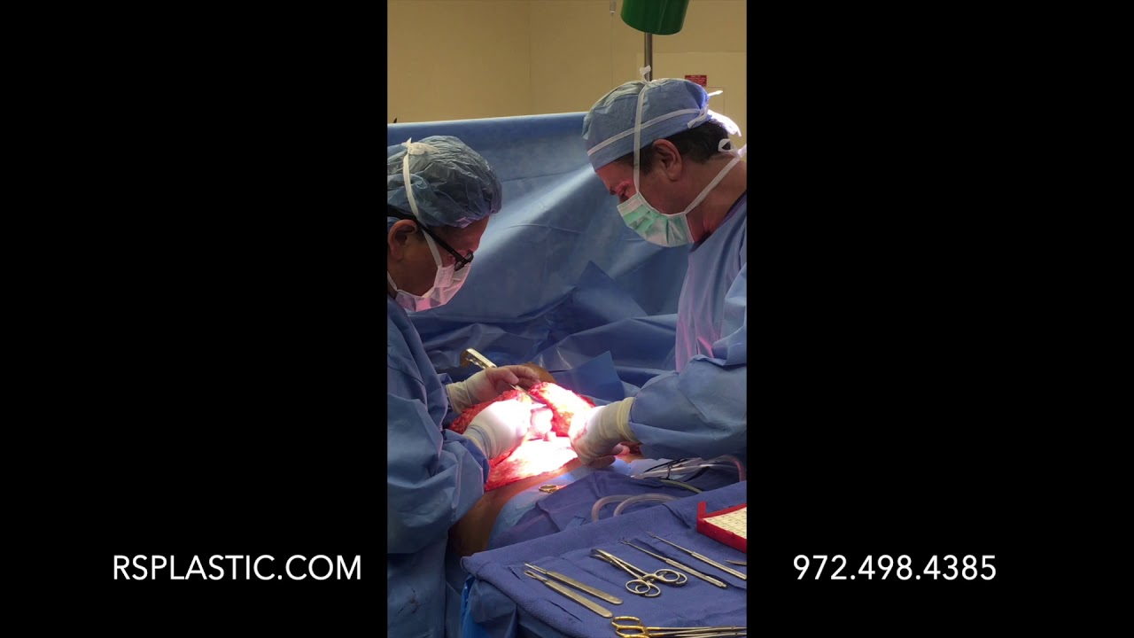 DALLAS TUMMY TUCK | Slim Your Waistline With Custom Corset Stitching ...