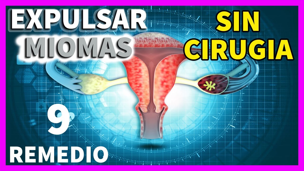 9 Remedio natural para expulsar miomas uterinos sin cirug1as - YouTube