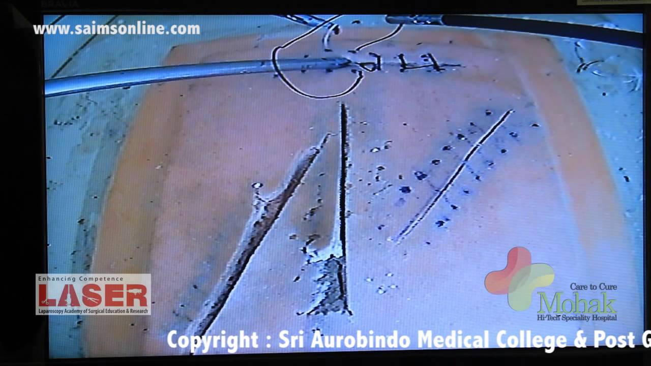 Intrcorporeal Vaginal Vault Closer By Suturing - YouTube