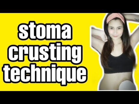 How i do "Crusting Technique" to my Stoma (Zoe) | Timelapse ...