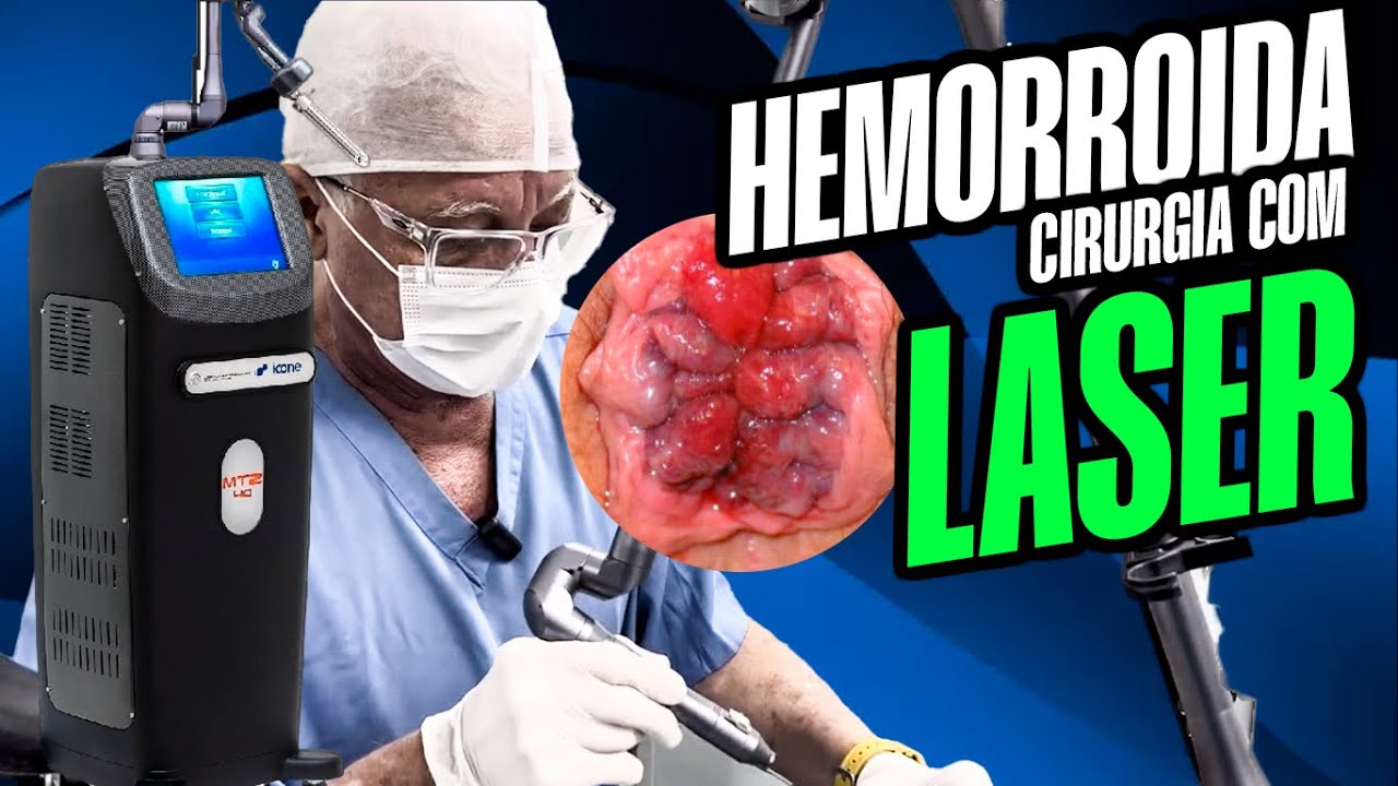 SIMULAÇÃO:Cirurgia c/ LASER Hemorroidas quando indicar cirurgia laser c ...