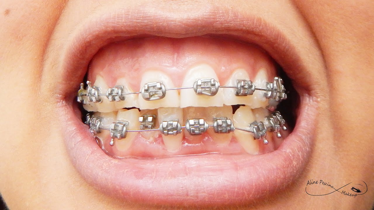 Ortodoncia, ¡Adiós dientes de Burro! - YouTube