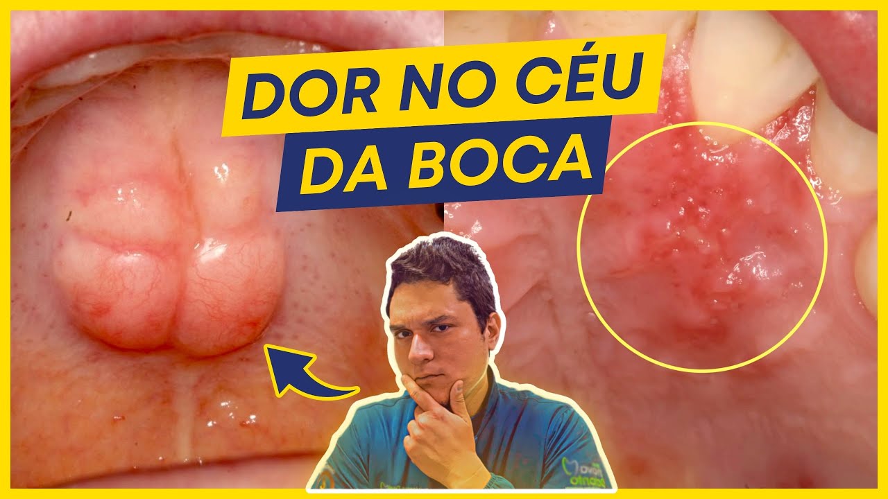 DOR NO CÉU DA BOCA: O QUE PODE SER? - YouTube