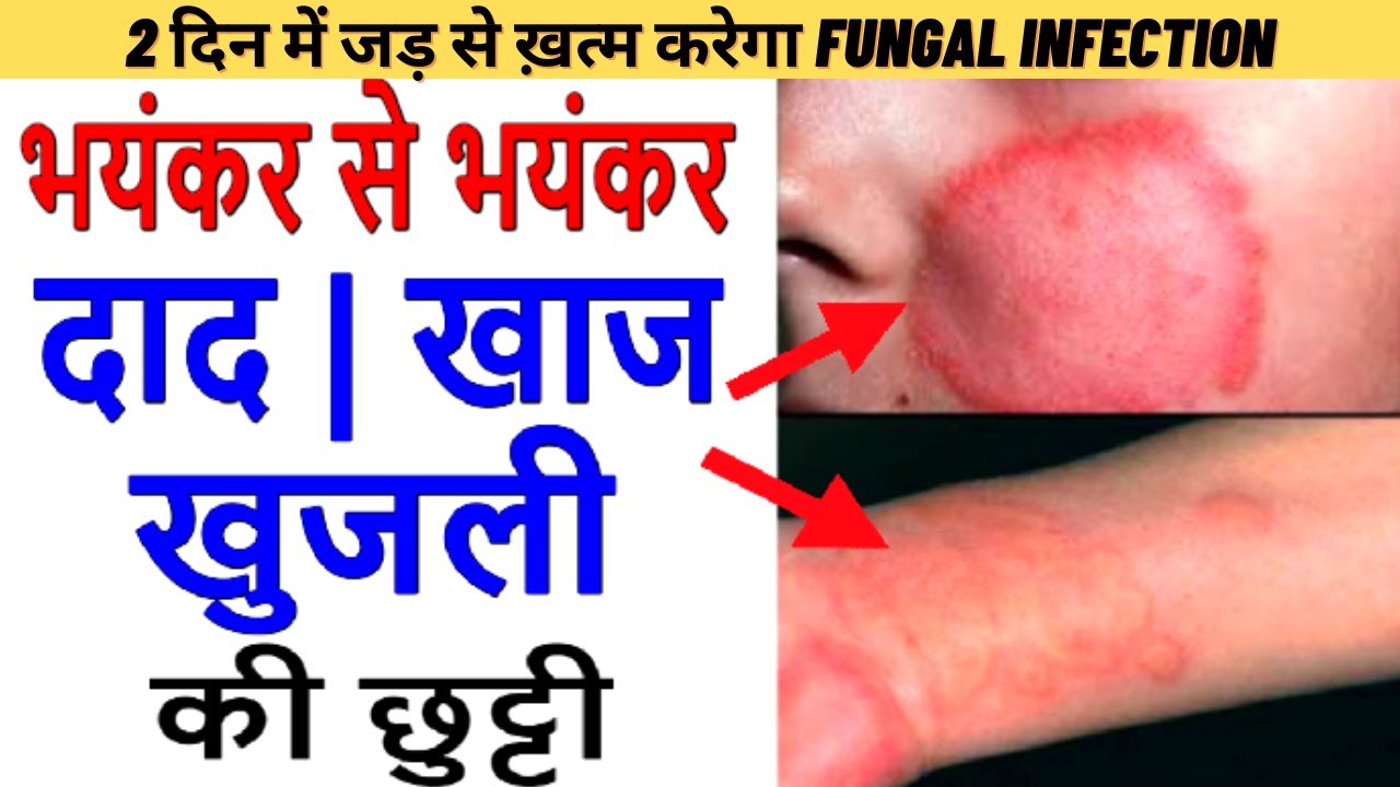 दाद खाज़ खुजली को 2 दिन में जड़ से ख़त्म करेगा Fungal Infection Home ...