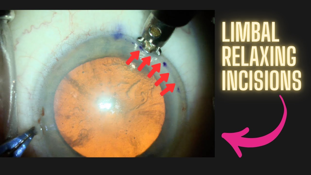 Limbal Relaxing Incision (LRI) Technique - YouTube