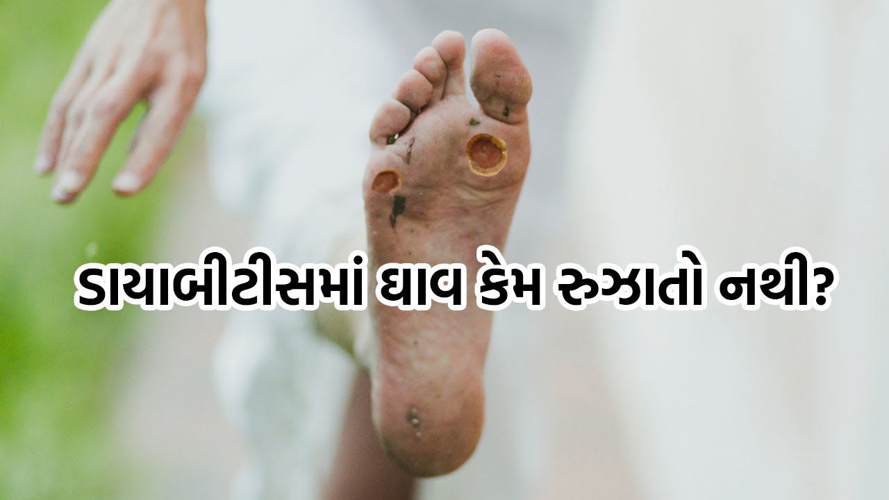 ડાયાબીટીસના દર્દીઓમાં ઘાવ રુઝાતો કેમ નથી ? | Interview with Dr. Dilip Variya - YouTube