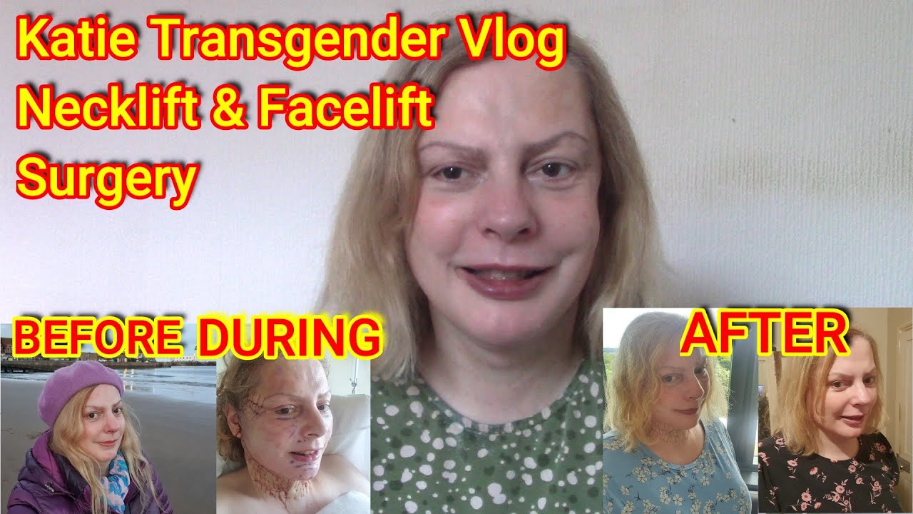 Katie Transgender Vlog Update - Necklift & Facelift Surgery (Platysma ...