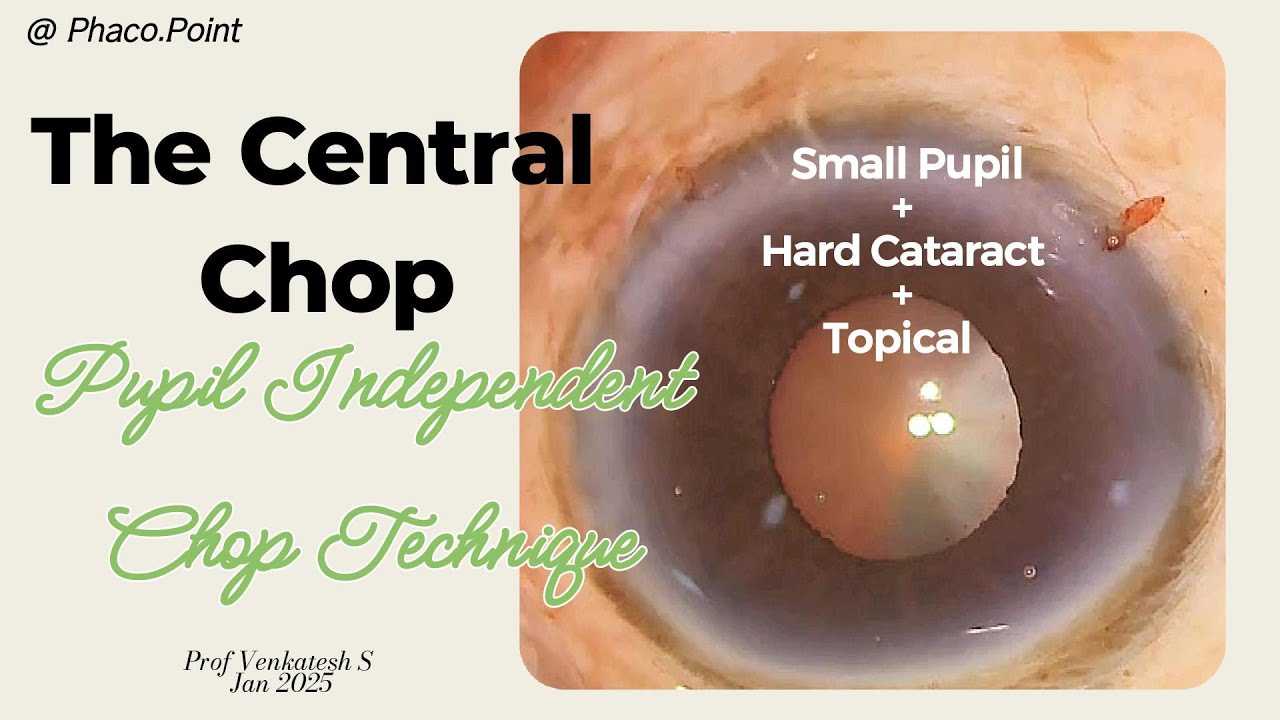 The central chop technique - A Pupil Independent Chop technique - Small ...