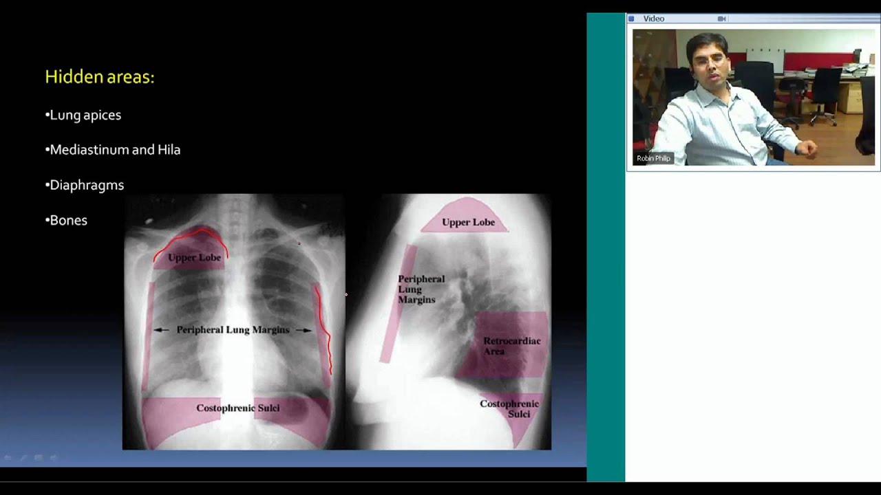 Radiology Teaching on Describing a CXR - YouTube
