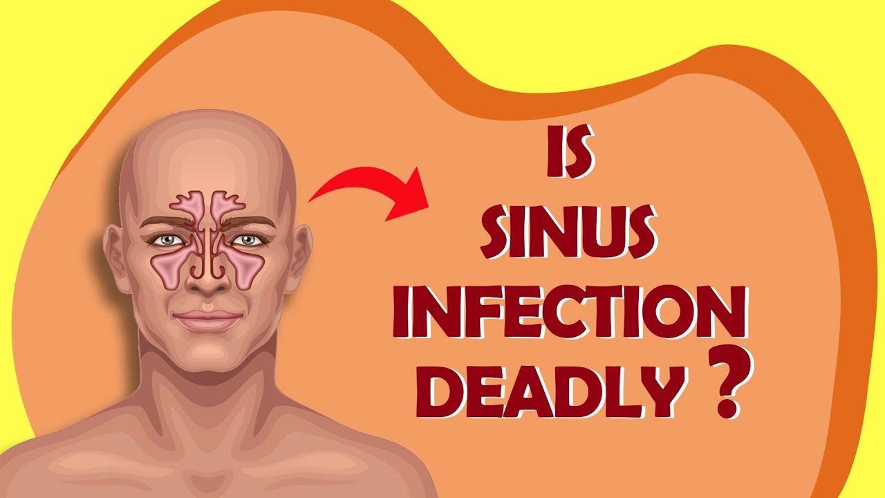 What is Sinusitis? | Symptoms | Causes | Home Remedy | Infection? - YouTube