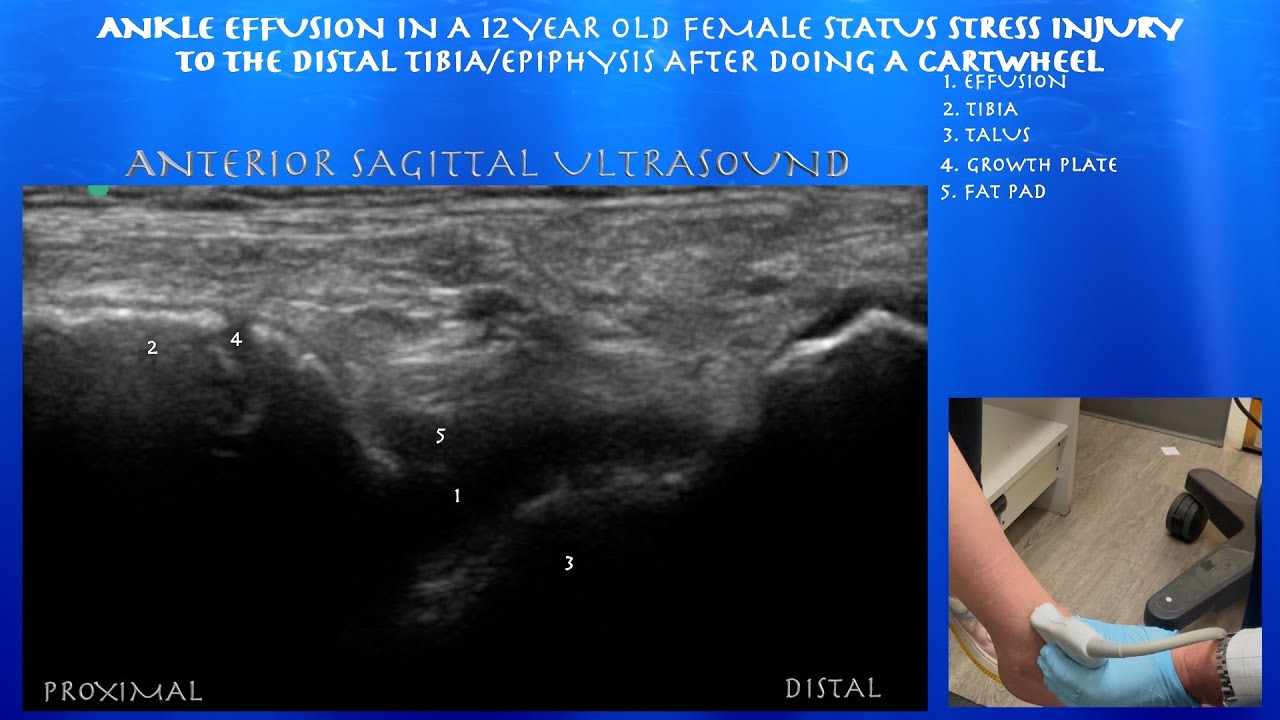 Ultrasound of a Ankle Joint Effusion in a 12 Year Old Female, by ...