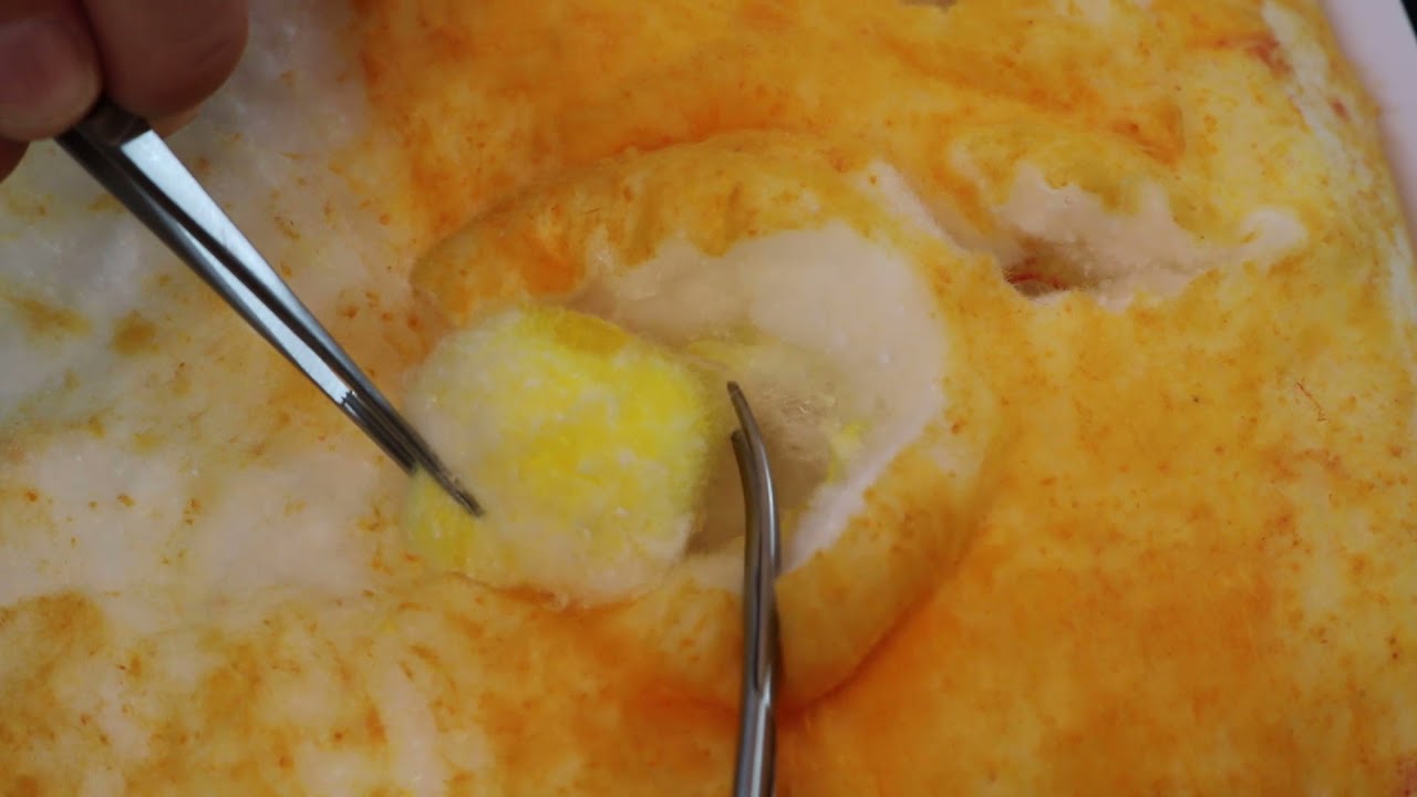 Sim*Dissect - 5: Excising Soft Tissue - YouTube