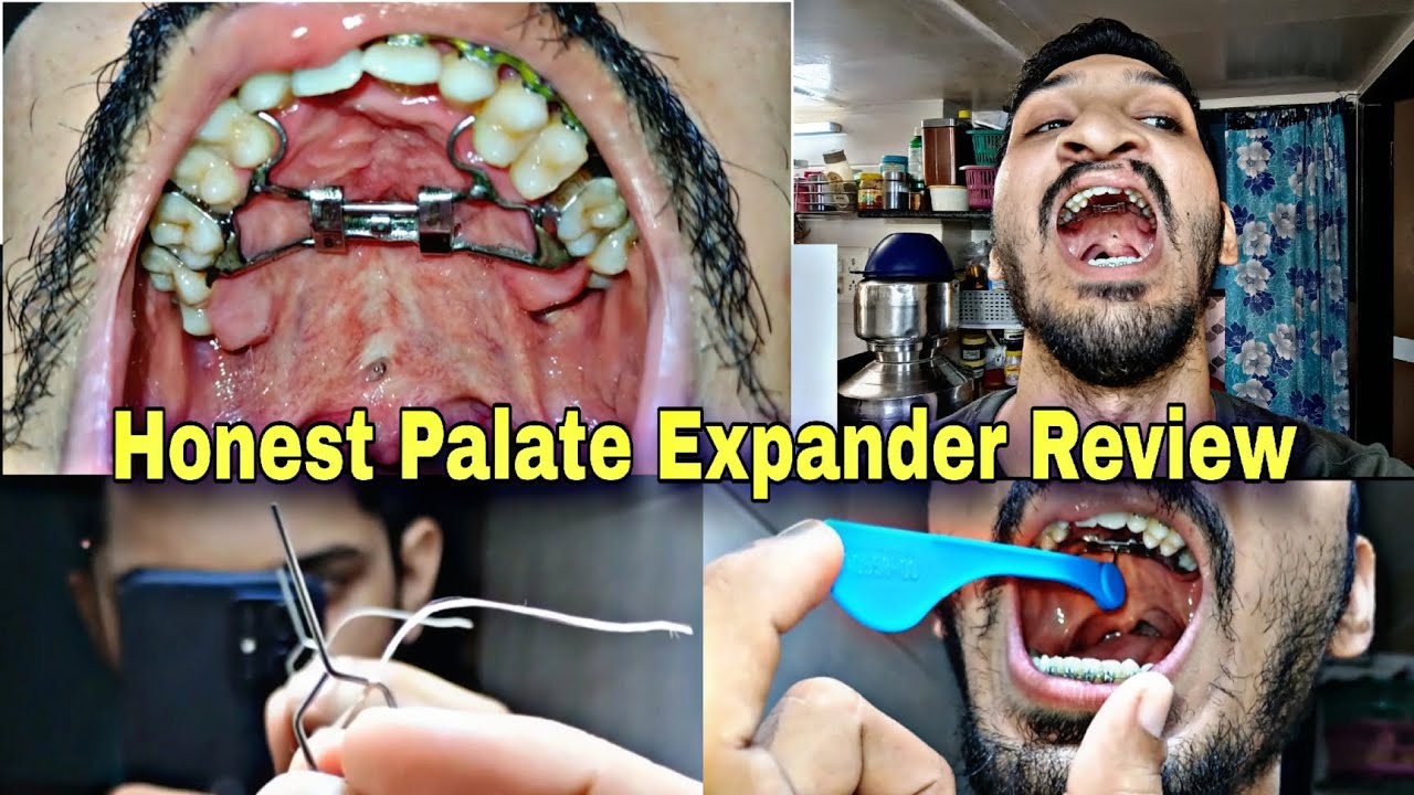 Unfiltered Palate Expander Experience Review Teeth Expander - YouTube