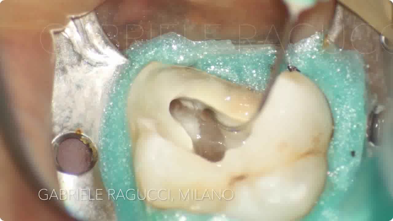 MOLARS ANATOMY PT1: UPPER SECOND MOLAR - YouTube