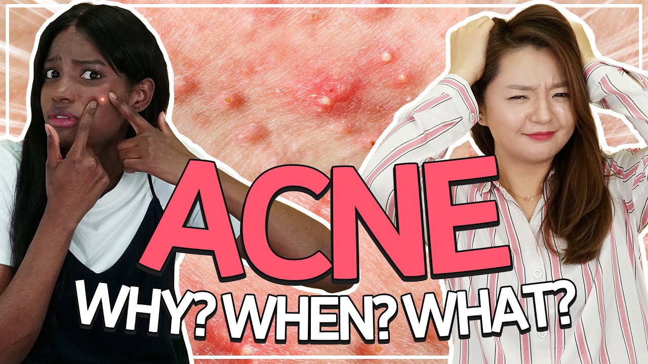 Different types of Acne and how to treat them : Root Time's Acne guide ...