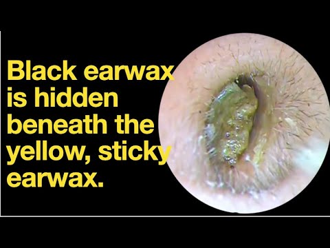 Black earwax is hidden beneath the yellow, sticky earwax.|ear wax ...