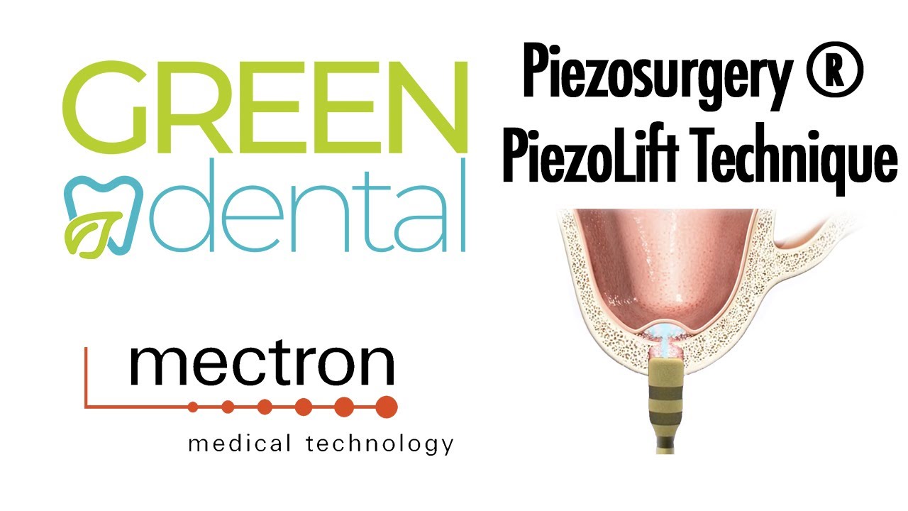 Piezosurgery®, PiezoLift Technique, Crestal Approach Sinus Lift, Mectron - YouTube