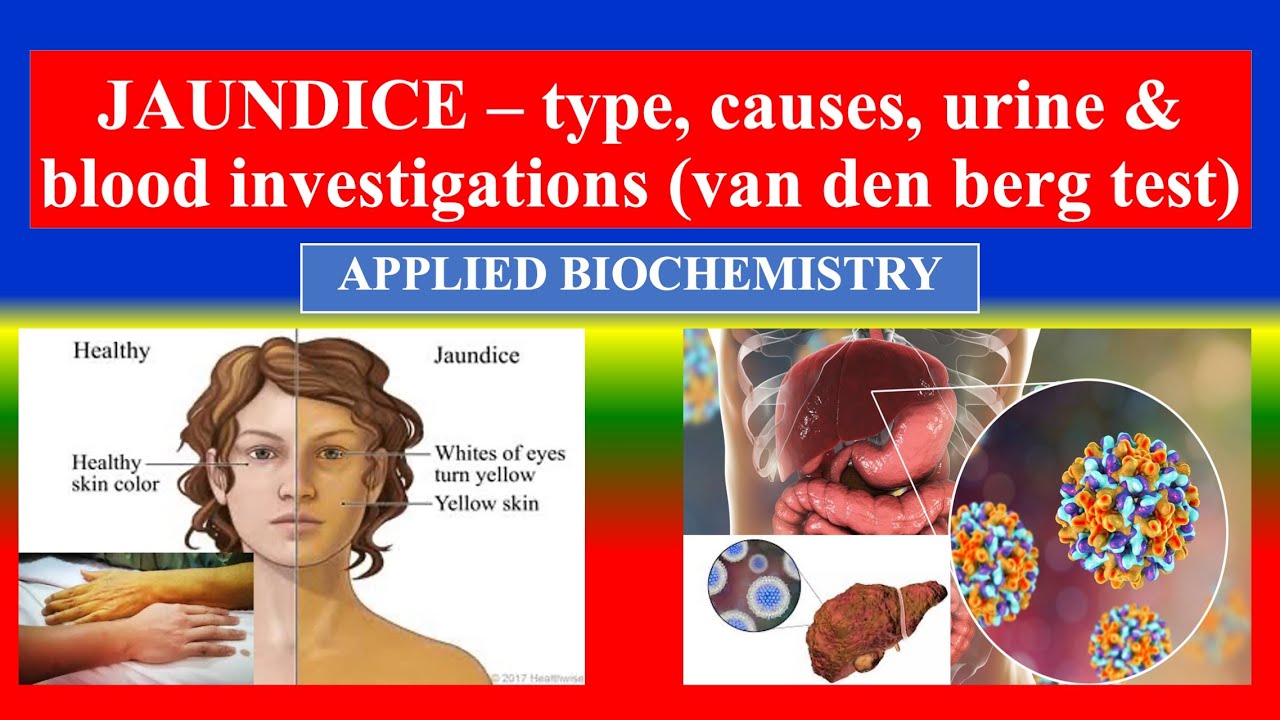 JAUNDICE – type, causes, urine & blood investigations van den berg test ...