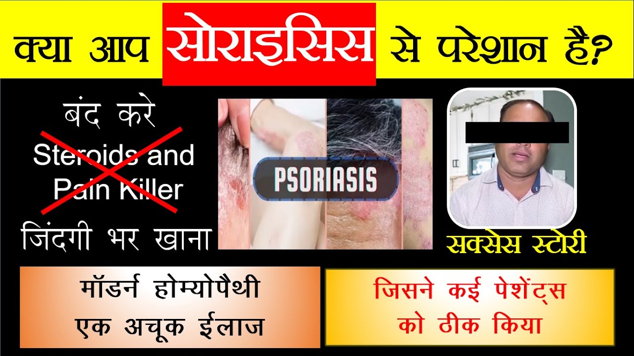 Psoriasis Permanent Treatment |Psoriasis Cure Success Story |Dr. Arpit ...